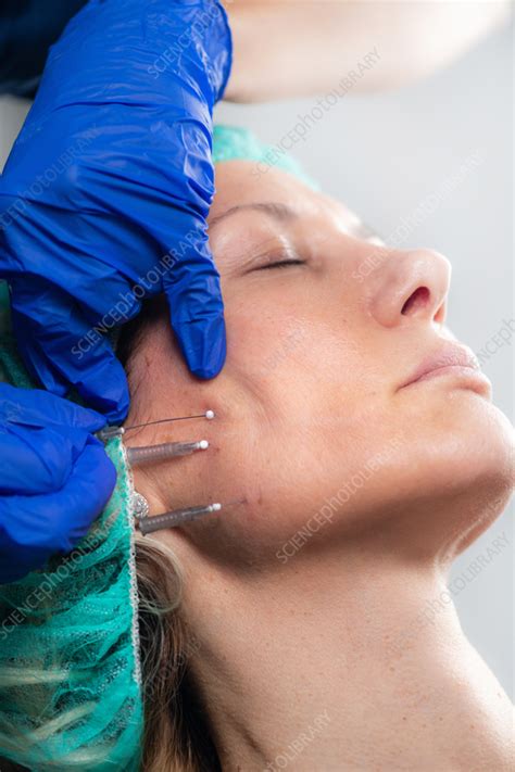 Mesotherapy Thread Face Lift Procedure Stock Image F0365159