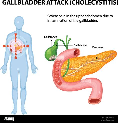 Illustration Of Gallbladder Inflammation And Abdominal Pain Stock