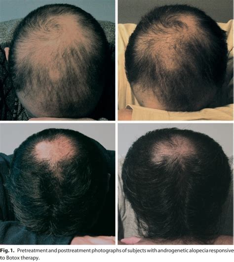 Botox Injections For Hair Growth In Men Hairguard