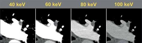 Optimisation Of Virtual Monoenergetic Reconstructions For The Diagnosis Of Pulmonary Embolism