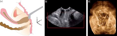 Bartholin Cyst Perineum