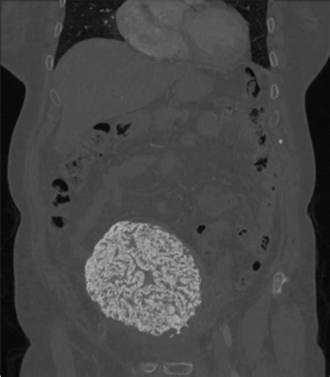 A Stone Like” Leiomyoma Causing Uterine And Bowel Perforation Eurorad