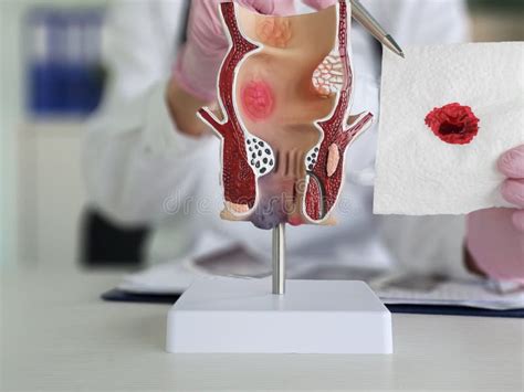 Doctor Anatomy Rectum And Napkin With Blood Stock Photo Image Of Constipation Blood