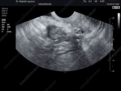 Menopausal Uterus And Ovaries Ultrasound Scan Stock Image C060