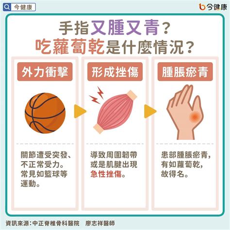 手指吃蘿蔔乾是什麼？手指挫傷勿搓揉！醫教price自救 今健康