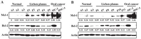 Myeloid Cell Leukemia 1 Mcl 1 Expression Is Associated With The