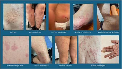 Frontiers Urticaria And Other Mimickers Of Urticaria