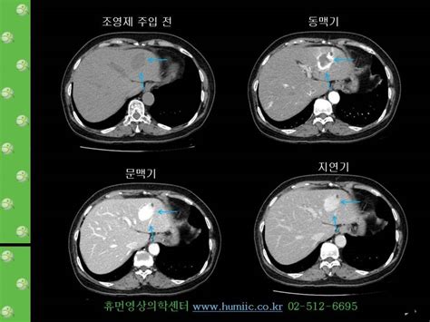 간암 과 간 혈관종 역동적 조영증강 간 Ct 소견 네이버 블로그