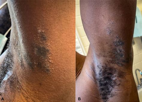 Dermatoscopic Rainbow Pattern In Lichen Planus Pigmentosus Inversus In