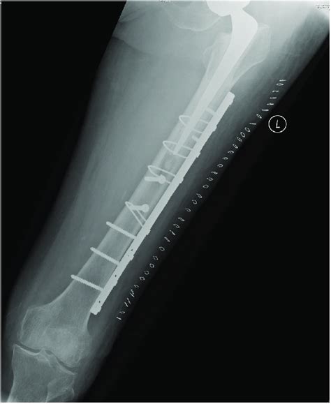 Open Reduction And Internal Fixation With Locking Cable Plate Post Op
