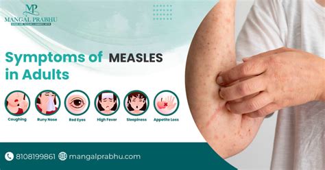 Measles Rash Early Stages