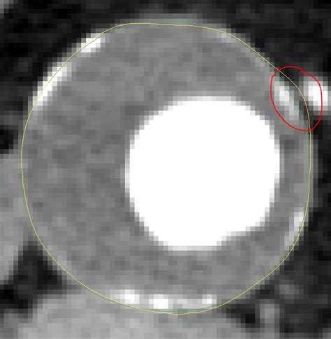 Registration Of Consecutive Ct Volumes Support 3d Slicer Community