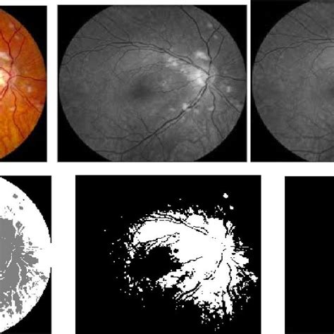 Pdf Detection Of Exudative Maculopathy From Retinal Fundus Images