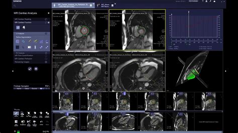 The Role Of Computational Models In Radiation Treatment Computational