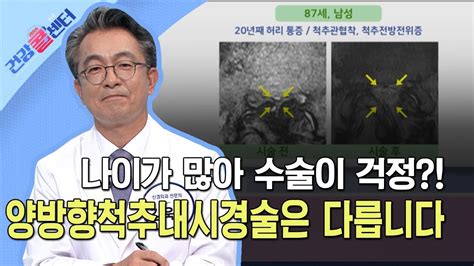 [건강 콜센터] 나이가 많아 수술이 걱정 … 양방향척추내시경술은 다릅니다 Youtube