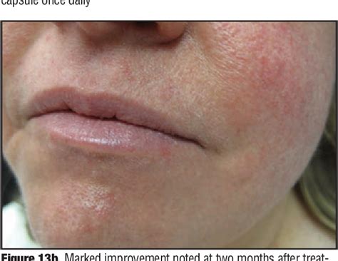 Figure 13 From Management Of Papulopustular Rosacea And Perioral