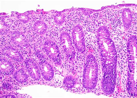 Pathology Outlines Sexually Transmitted Infectious Colitis Proctitis