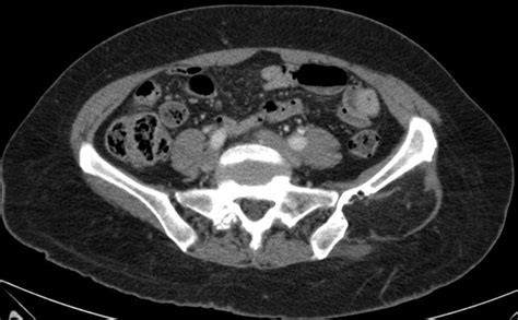 Hibernoma With Broad Bone Erosions Eurorad