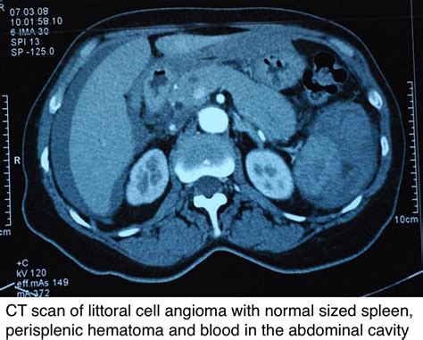 Pathology Outlines Littoral Cell Angioma