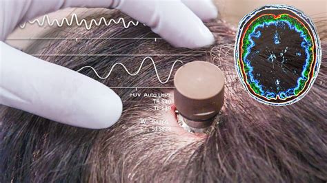 Cómo funciona el chip cerebral de Elon Musk que controla dispositivos con el pensamiento Infobae