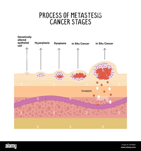 Metastasis Diagram