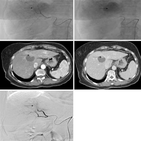 Transarterial Chemoembolization For Hepatocellular Carcinoma A Four Download Scientific