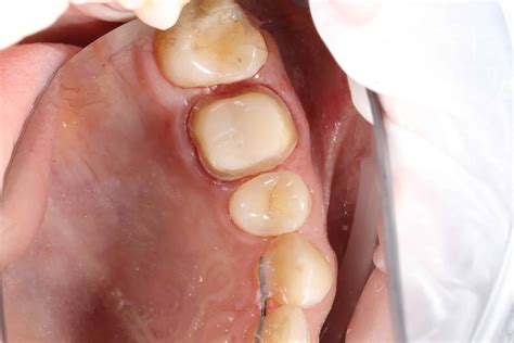 Fabrication And Placement Of A Ceramic Crown On A Severely Decayed