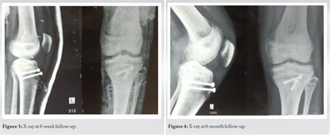 A Type IV Tibial Tuberosity Avulsion Fracture In An Adolescent A Case Report Journal Of