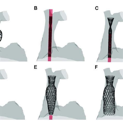 Different Phases Of The Deployment Of The Svc Device From The A Download Scientific Diagram
