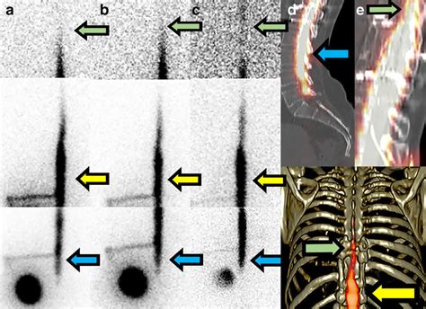 CSF Flow Obstruction In A Year Old Female With Spasticity With A Download Scientific Diagram