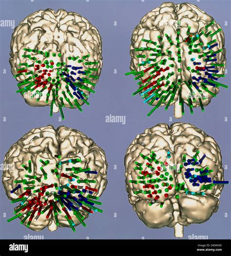 Visual Cortex Brain Areas 3 D Magnetic Resonance Imaging Mri Scans Of The Brain Mapped To