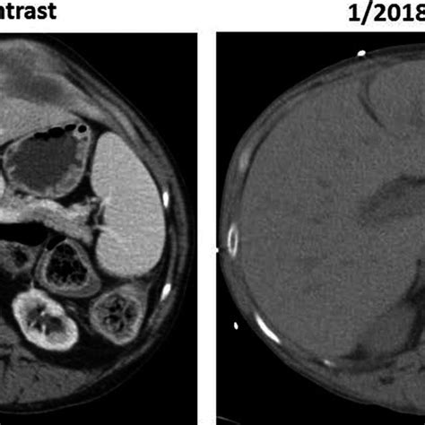 Large Mediastinal Nodal Metastasis Causing Have Left Vocal Cord