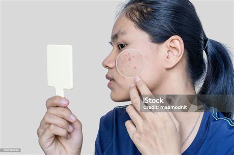 줌 서클에서 여드름 피부를 가진 젊은 여자의 닫기 동그라미가 있는 아시아 여성의 얼굴은 여드름 치료 전후의 피부 문제를 보여줍니다 미용사 개념입니다 20 29세에 대한 스톡