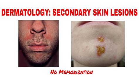 Ulcer Skin Lesion