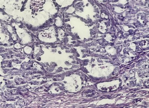 Clear Cell Carcinoma Ovary Histopathologyguru