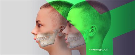 Double Chin And Overbite What They Have In Common Ach