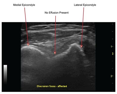 Pocus View Of Olecranon Fossa Of Elbow In Transverse Plane No Effusion Download Scientific