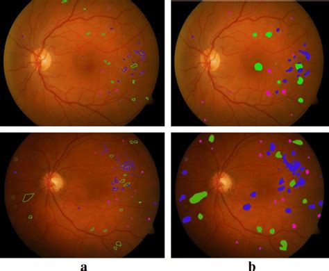 Segmentation Output Image Of The Example Retina Image A Manually