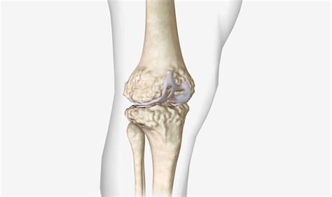 Premium Photo Post Traumatic Arthritis In Knee