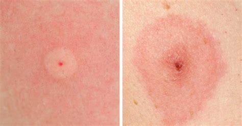 How To Identify Bug Bites A Helpful Guide