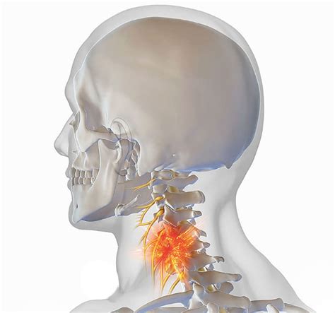 სპინალური ნერვები C1 C4 პირველი 4 სპინალური ნერვი C1 დან C4 მდე იყოფიან და ხელახლა ერთდებიან