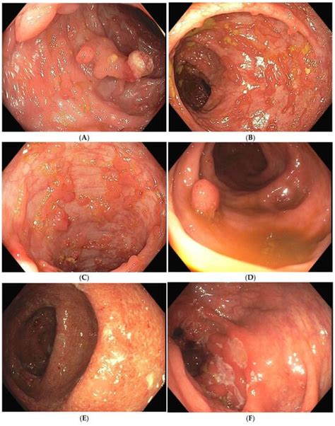 The Importance Of Post Inflammatory Polyps Pips In Colorectal Cancer