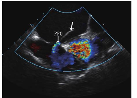四、彩色多普勒血流图像 心脏超声诊断图谱