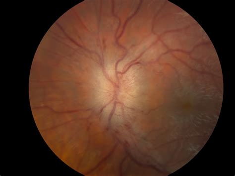 How To Grade Papilledema