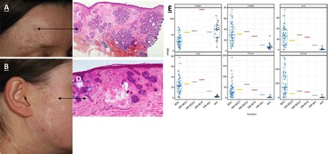 Clinical And Histological Presentation Of Basal Cell Naevi Bcn And Download Scientific