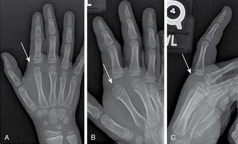 Open Reduction For Metacarpophalangeal Joint Dislocation Clinical Tree