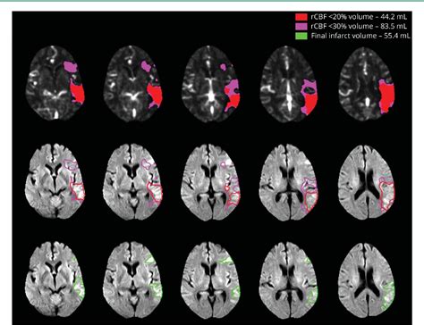 Figure 1 From Accuracy Of Ct Perfusion Based Core Estimation Of Follow Up Infarction Semantic