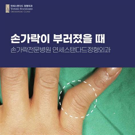 손가락 골절 수술 전문 병원 정형외과 고를 때 네이버 블로그