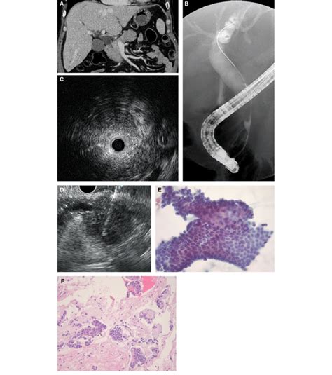 Suspected Malignant Biliary Stricture Of The Extrinsic Type A