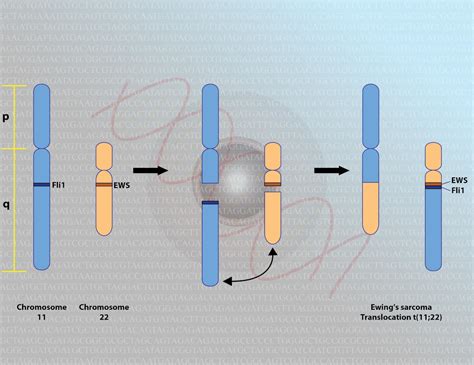 Sarcoma Di Ewing Cause Sintomi E Cura